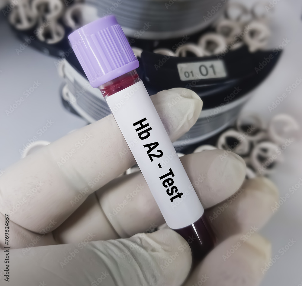 Blood sample tube for HPLC (High Performance Liquid Chromatography ...