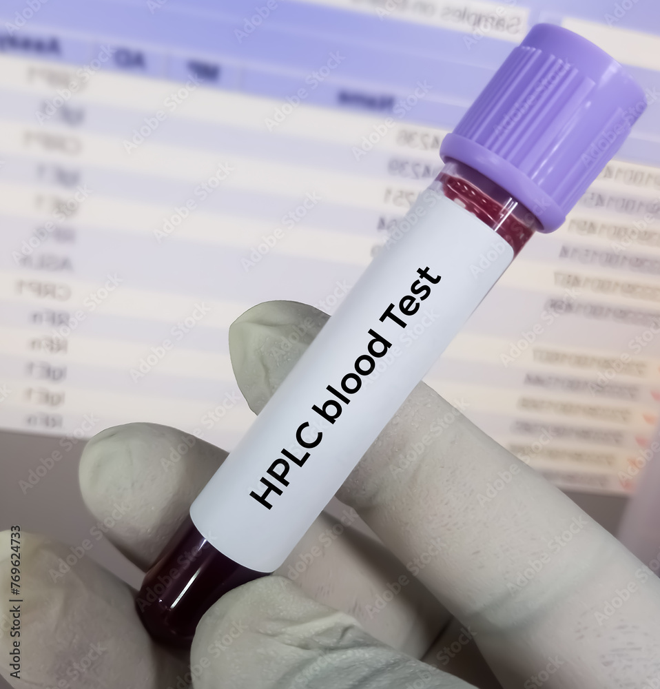 Blood sample tube for Hemoglobin variant analysis HPLC test, to ...
