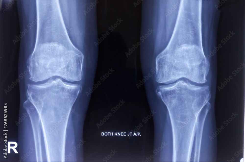 X-ray of both knee joint AP and lateral view. Osteophytes present ...