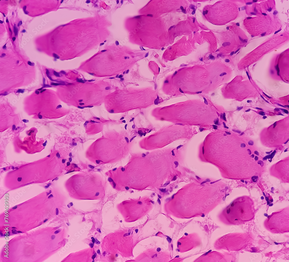 Microscopic image of above knee amputation. Section show fibro ...