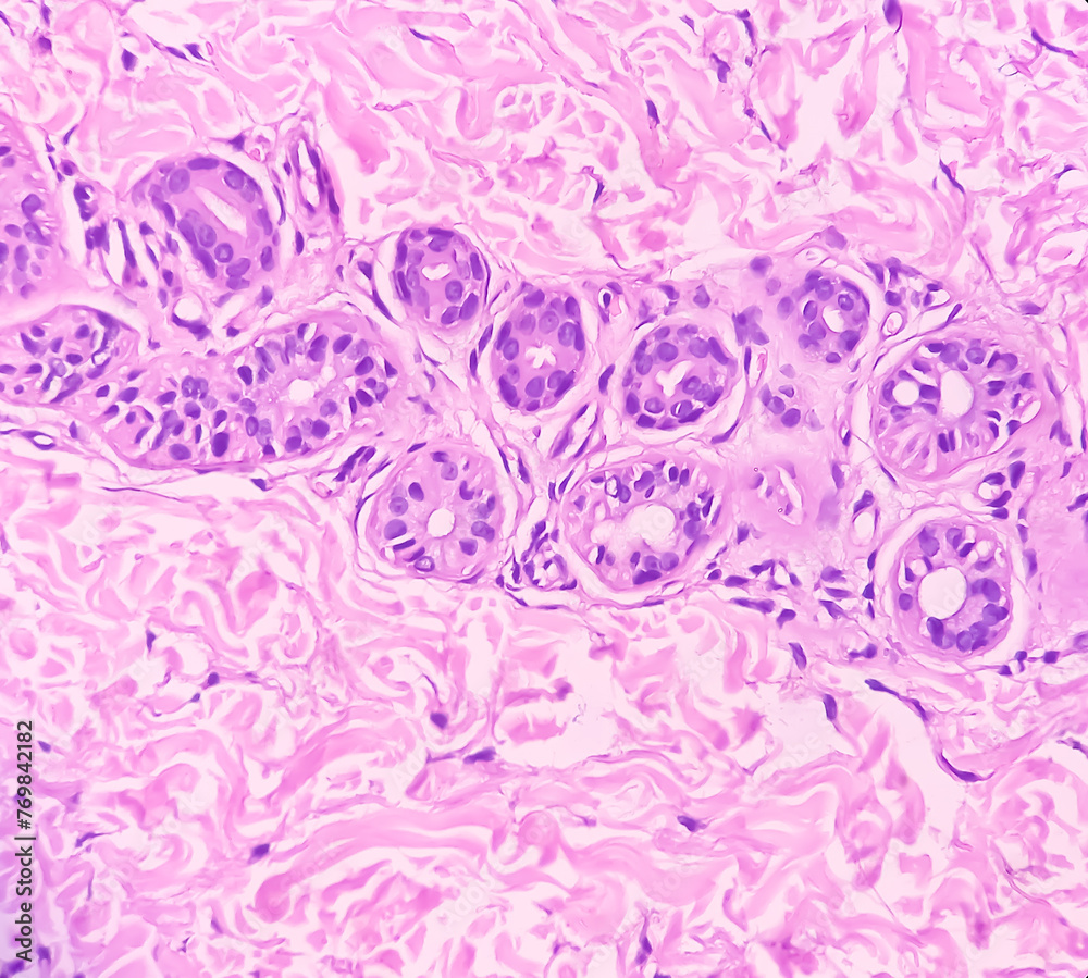 Hand skin tissue (biopsy) : Prurigo nodularis. Microscopically show ...