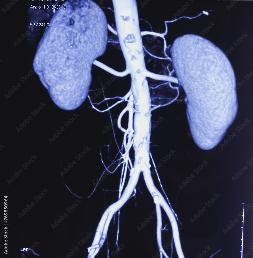 CT angiogram (CTA) shown the abdominal aorta, kidney and common iliac ...