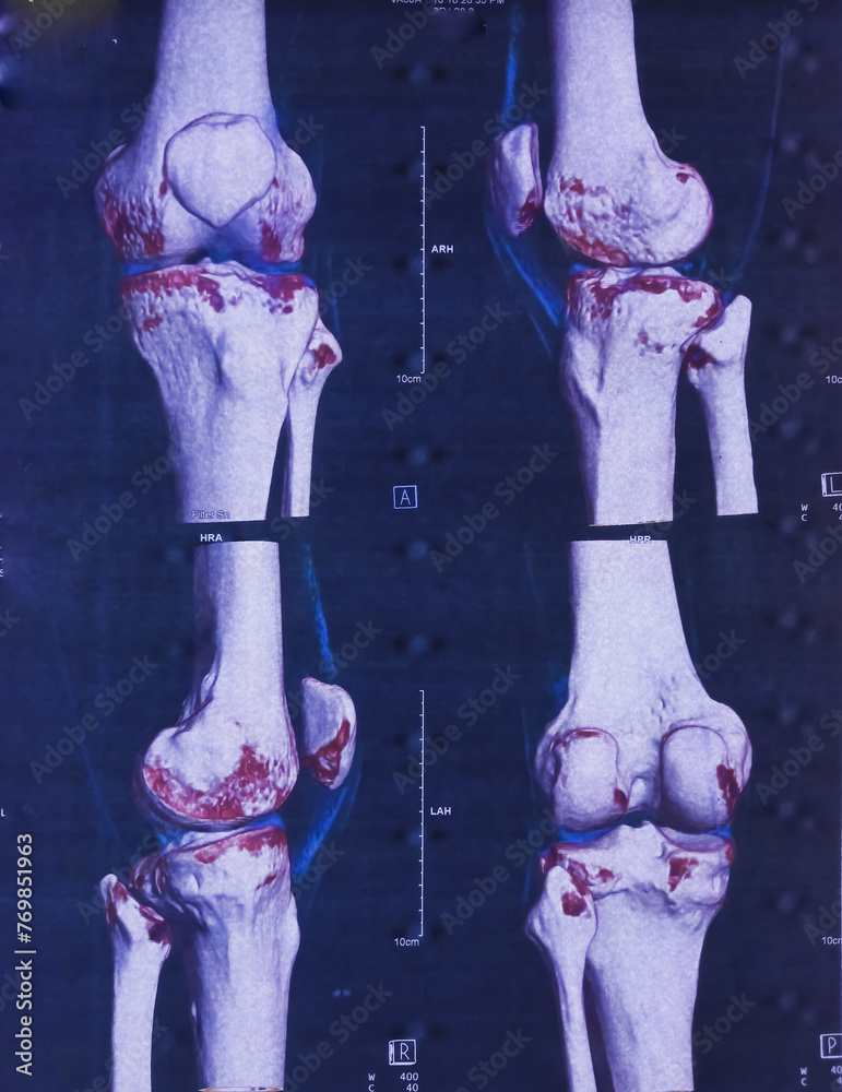 CT scan of Knee joint 3d image. knee joint alignment and congruity ...