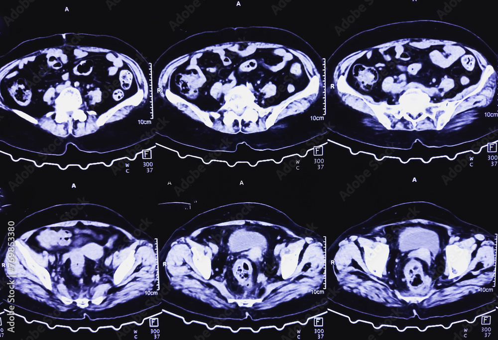 MRI (Magnetic Resonance Imaging) scan of pelvis (female). Ca rectum ...