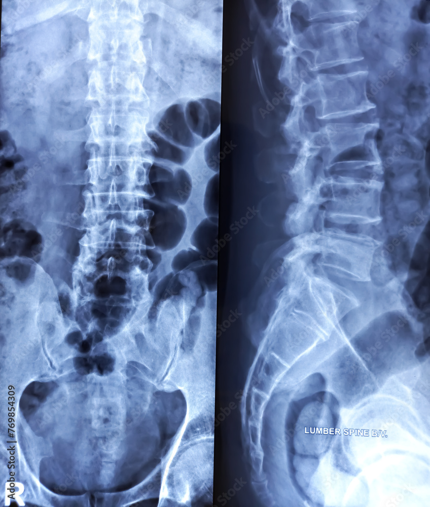 X-ray of Lumbosacral spine both view. Degenerative change at lumbar ...