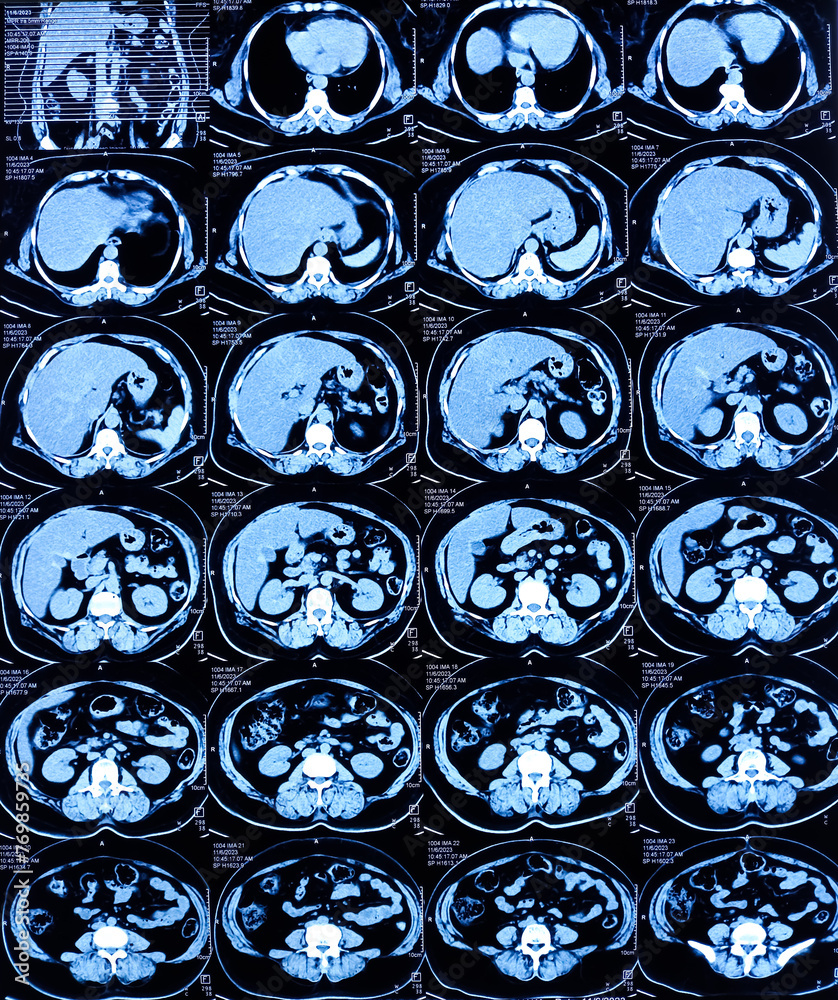MRCP film of MRI of abdomen. Hepatic parenchymal tiny calcification ...
