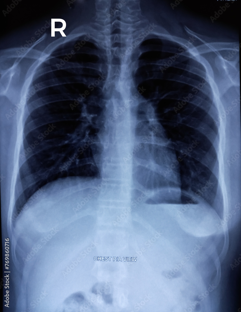 Chest x-ray PA view film. Normal chest radiograph. Posterior anterior ...