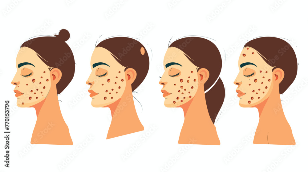 Cartoon Stages of acne formation in the human skin Stock Vector | Adobe ...