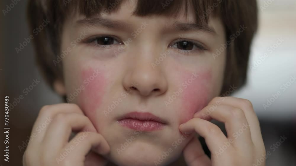 Child Scratching Red Rash on Face. Boy Scratches Atopic Skin ...