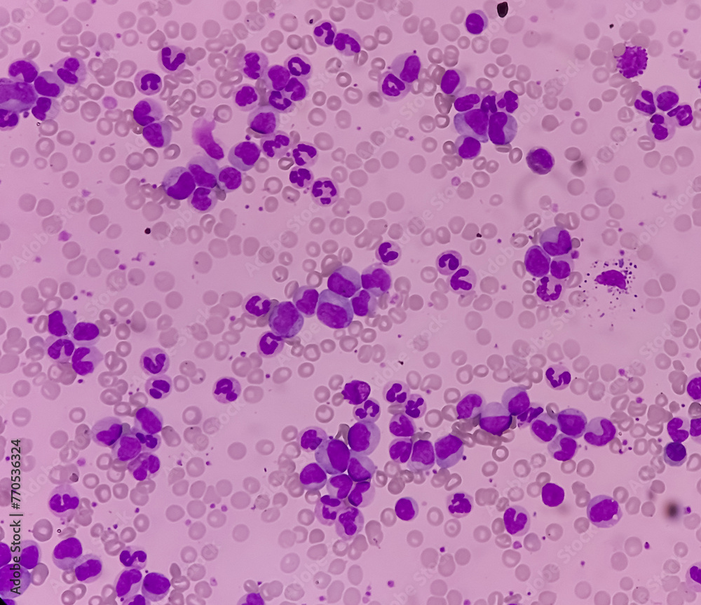 Blood cancer. Chronic myelogenous leukemia, also known as Chronic ...