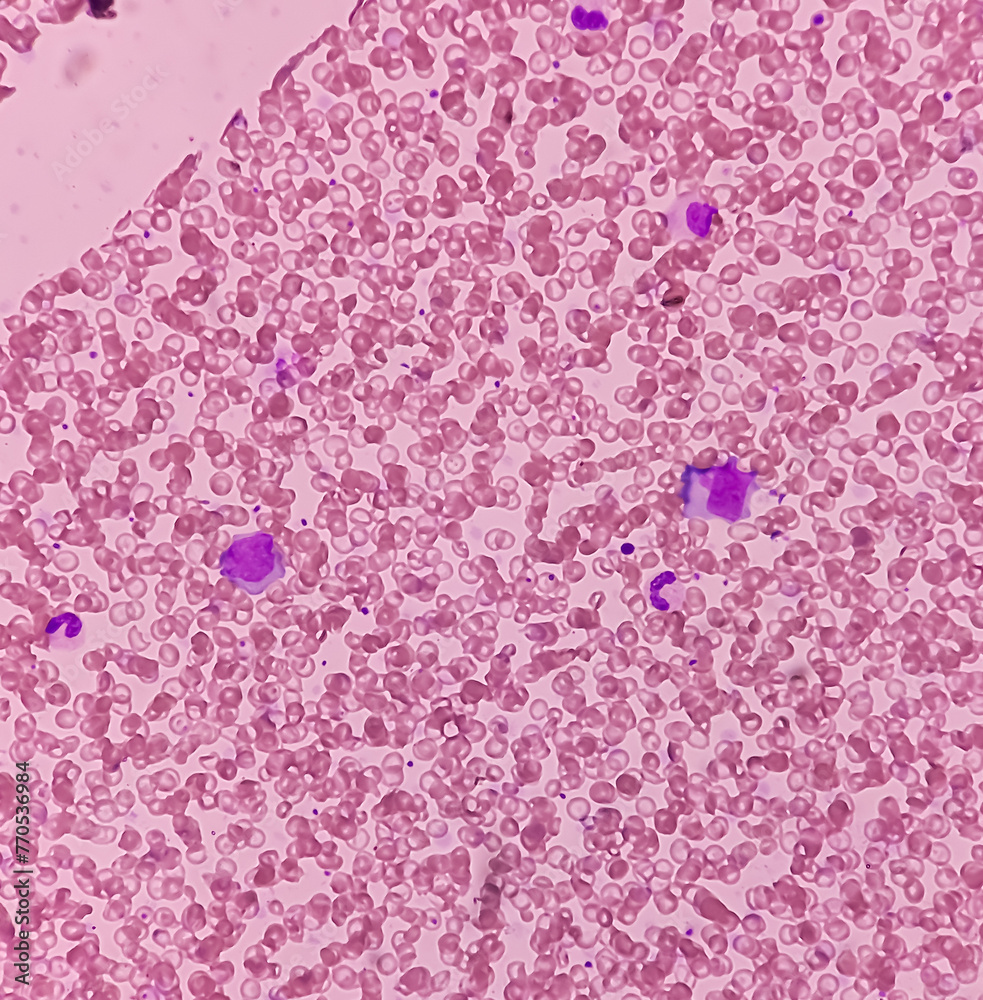 Acute leukemia, ALL(Acute lymphoblastic leukemia), peripheral blood ...