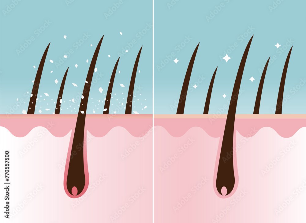 Comparison of dandruff in hair and healthy hair on scalp layer vector ...