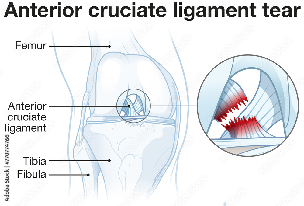 Poster Anterior cruciate ligament tear – Wall Art | UkPosters