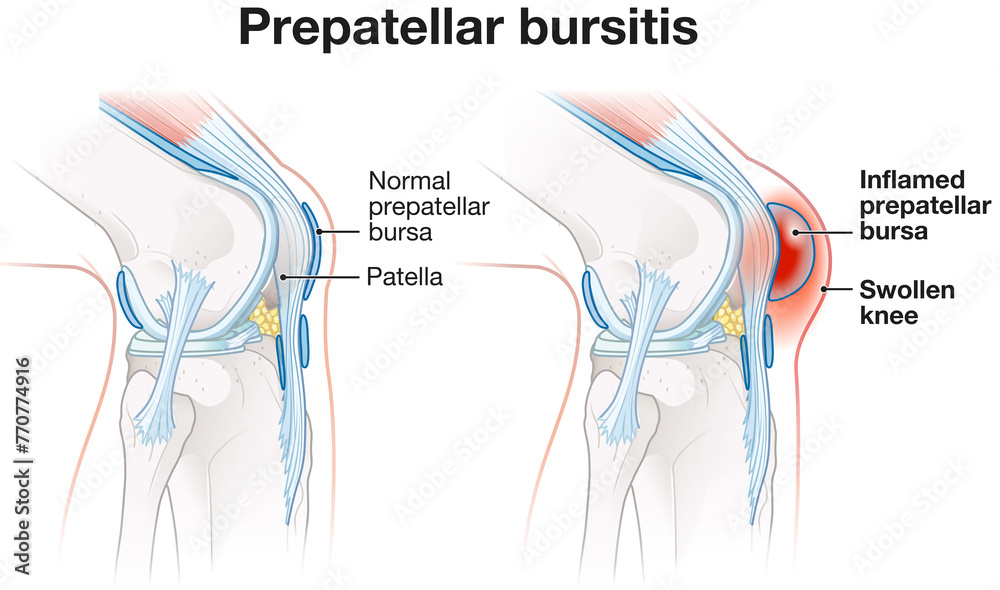 Poster Prepatellar bursitis.Labeled medically illustration – Wall Art ...