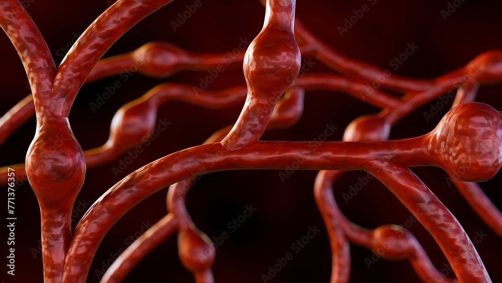 3d rendering of Hairy cell leukemia (HCL) is a rare type of chronic leukemia that develops ...