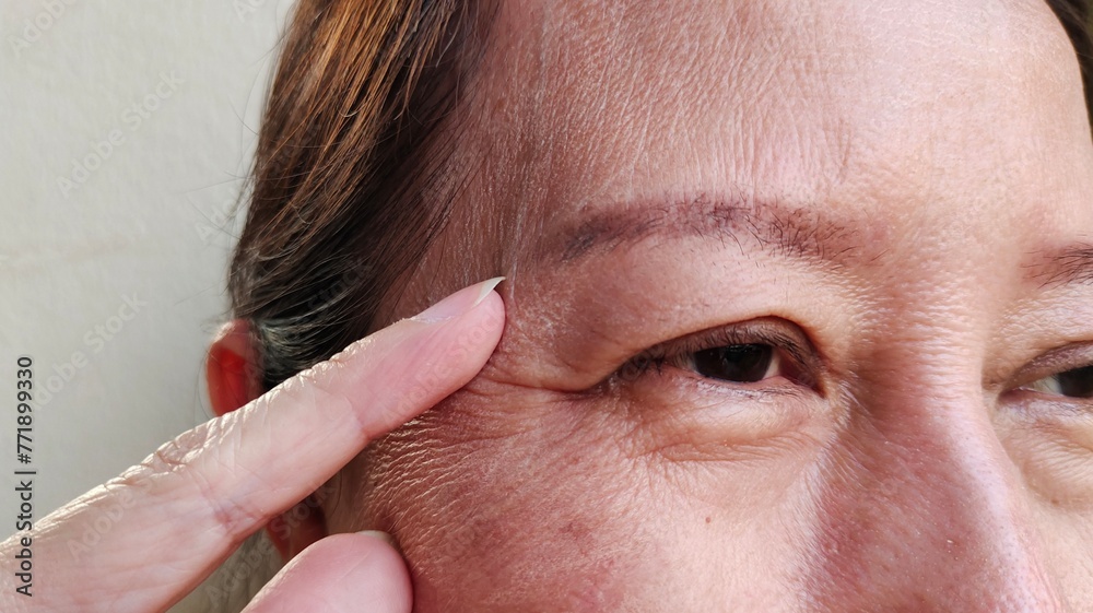 close up of the flabbiness and wrinkle beside the eyelid, Flabby skin ...
