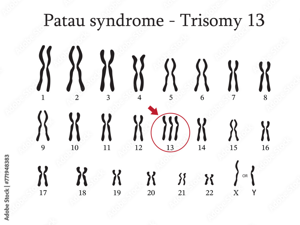 Karyotype of Patau syndrome also known as trisomy 13, is a genetic ...