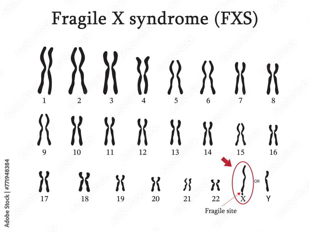 Plakát The Karyotype of Fragile X syndrome (FXS) is a genetic disorder ...