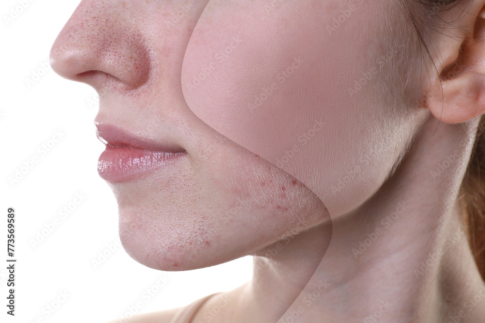 Acne problem, collage. Photo of woman divided into halves before and ...
