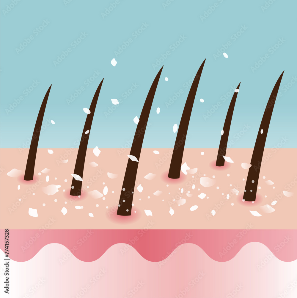 Diagram of dandruff hair on scalp layer vector illustration on aqua ...
