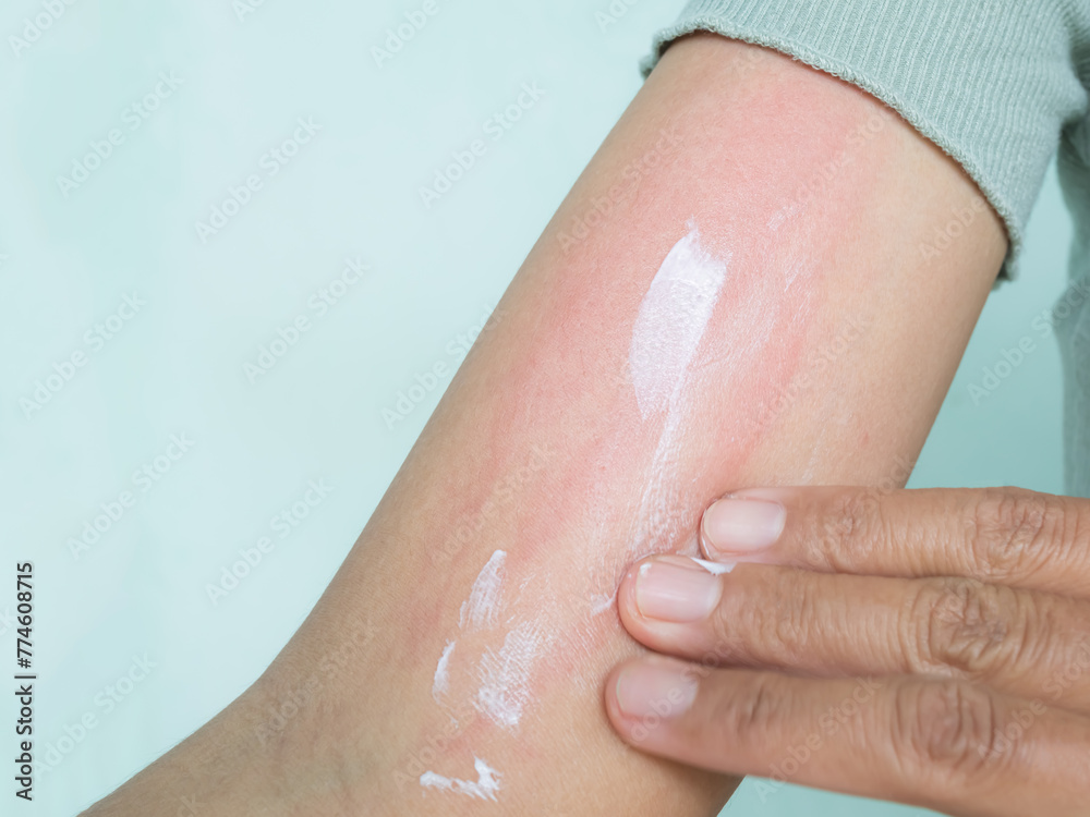 Hand with Urticaria Allergy Itchy Rash Eczema Itch Woman from Food,Air ...