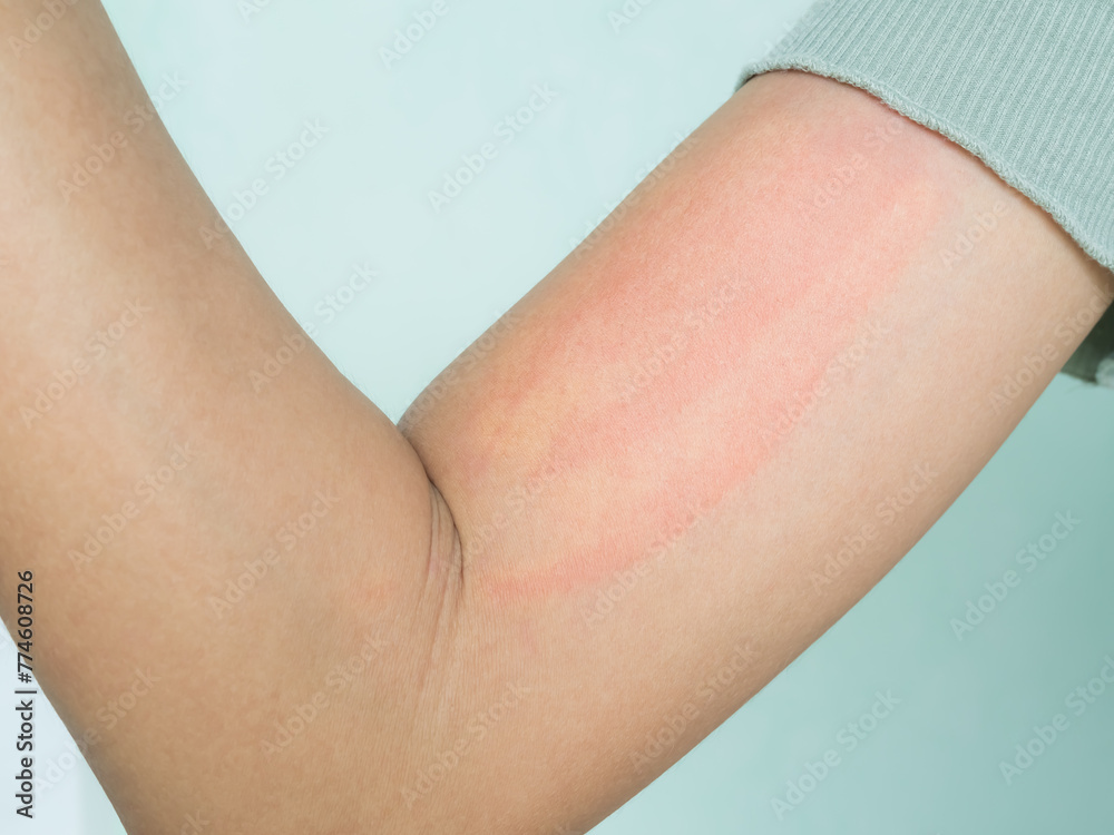 Hand with Urticaria Allergy Itchy Rash Eczema Itch Woman from Food,Air ...