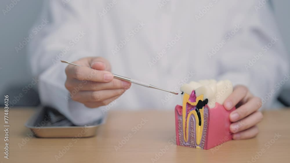 Dentist with tooth Anatomy model. Oral Teeth decay and disease, Scrape ...