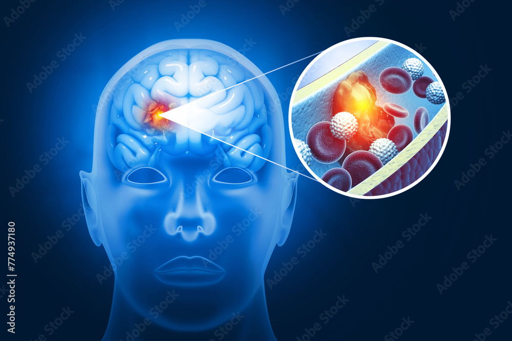 Atherosclerosis Stroke. A blood clot in the vessels of the human brain ...