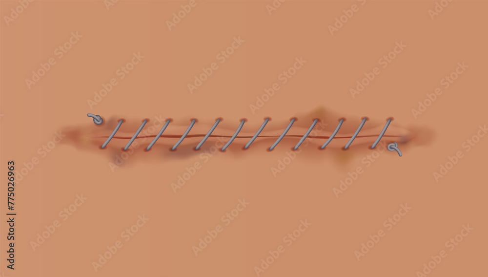 Healing wounds, skin scar, stitched gash and cut. Realistic surgical ...