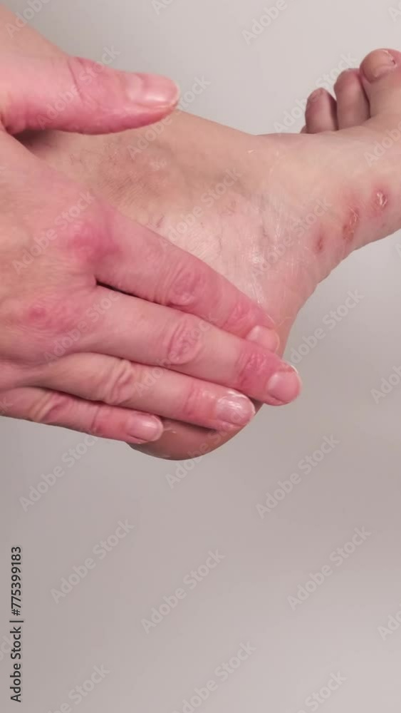 Woman applying steroid or cortisol creme on her foot. Medical treatment ...