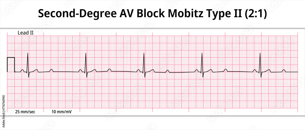ECG Second Degree AV Block Mobitz Type 2 (2:1) - 8 Sec ...