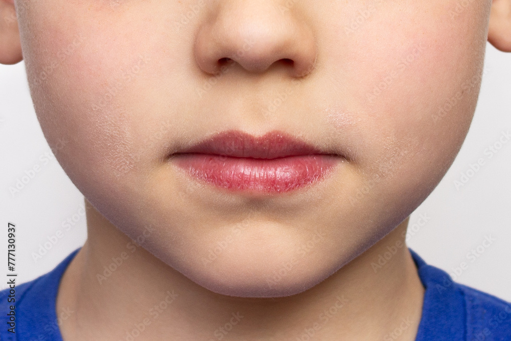 Dry chapped lips of a child close-up. Sensitive skin around the mouth ...