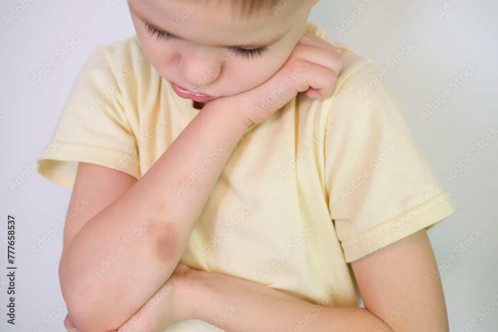 There are skin abrasions with bruises on child's hand close-up. Boy ...