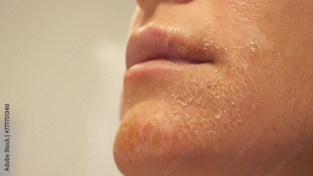 CLOSE UP, DOF: Damaged flaky skin on the face of an unrecognizable ...