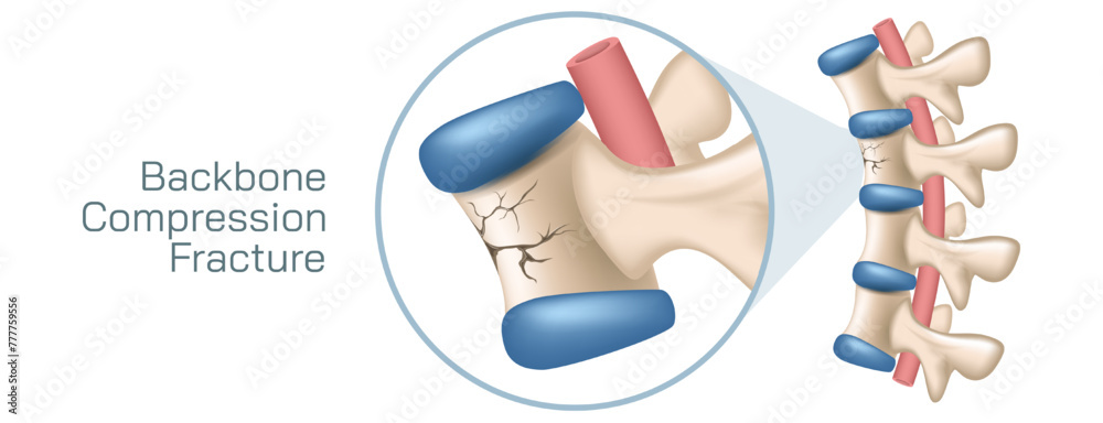 Backbone spinal cord compression fracture. Vertebra and compression or ...