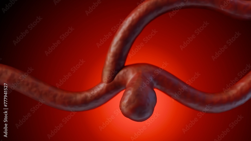 3d rendering of a saccular aneurysm, also known as a berry aneurysm, is ...