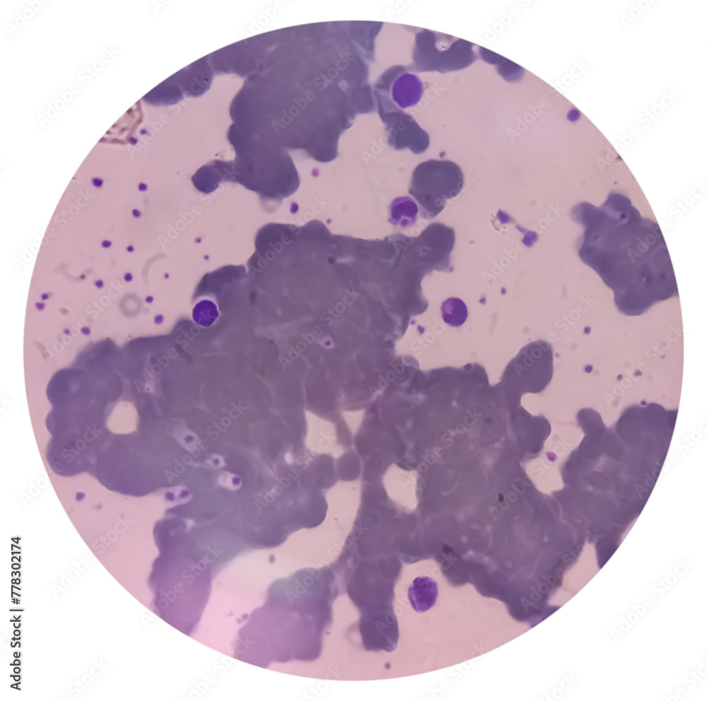 Cold agglutinins disease, RBCs to clump together (agglutinate) at low ...