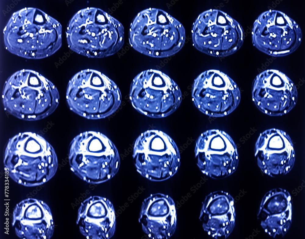 MRI (Magnetic resonance imaging) scan of leg. Lytic bony lesion at ...