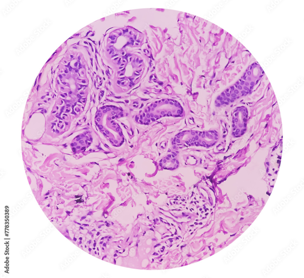 Hand Skin Tissue Biopsy Prurigo Nodularis Microscopically Show