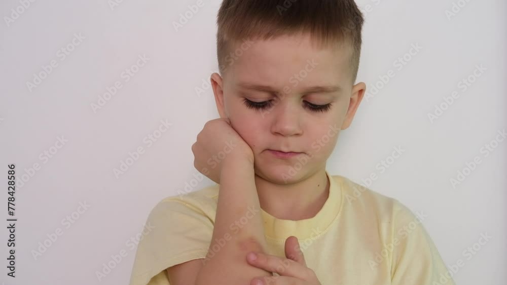 There are skin abrasions with bruises on child's hand close-up. Boy ...