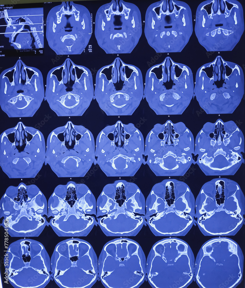 CT scan of PNS: Hypertrophied both inferior nasal turbinates with ...