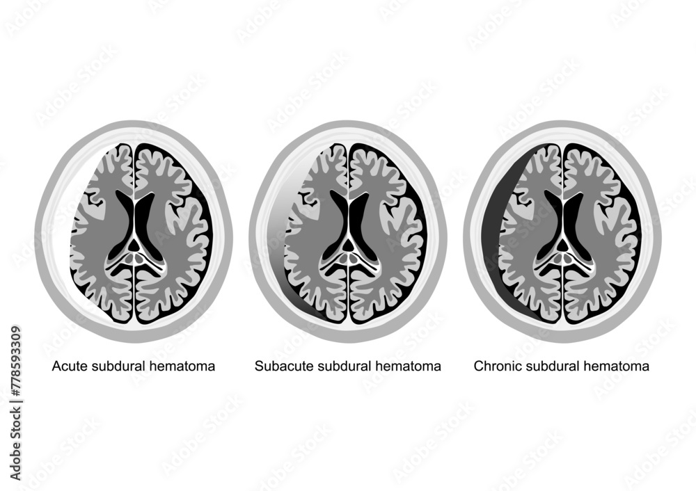 Photo Stages of subdural hematoma brain injury illustrated.., Teeradej ...