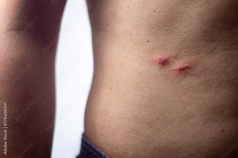 Atopic dermatitis, commonly referred to as eczema, manifests as ...