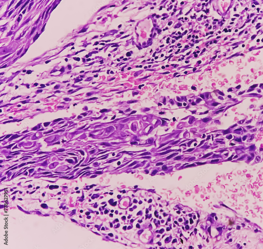 Photomicrograph of Rectal cancer. IBD. IBS. Squamous cell carcinoma of ...