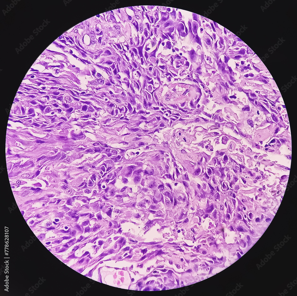 ภาพประกอบสต็อก Photomicrograph of Rectal cancer. IBD. IBS. Squamous ...