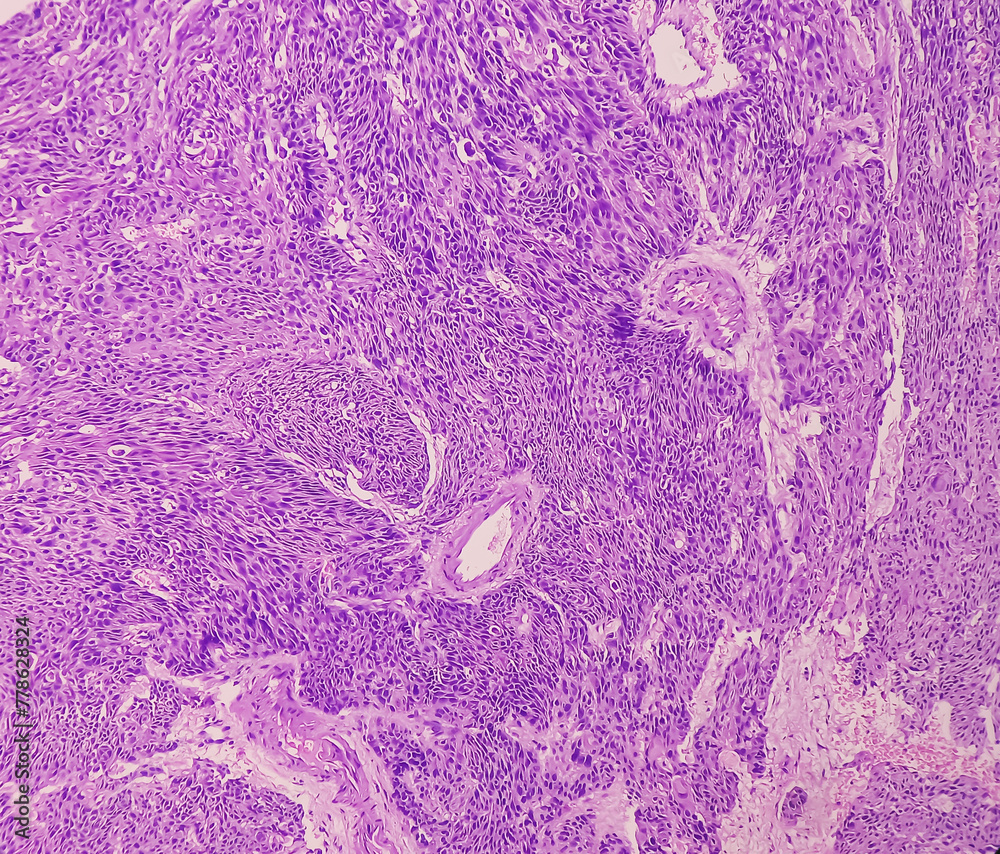 Photomicrograph of Rectal cancer. IBD. IBS. Squamous cell carcinoma of ...