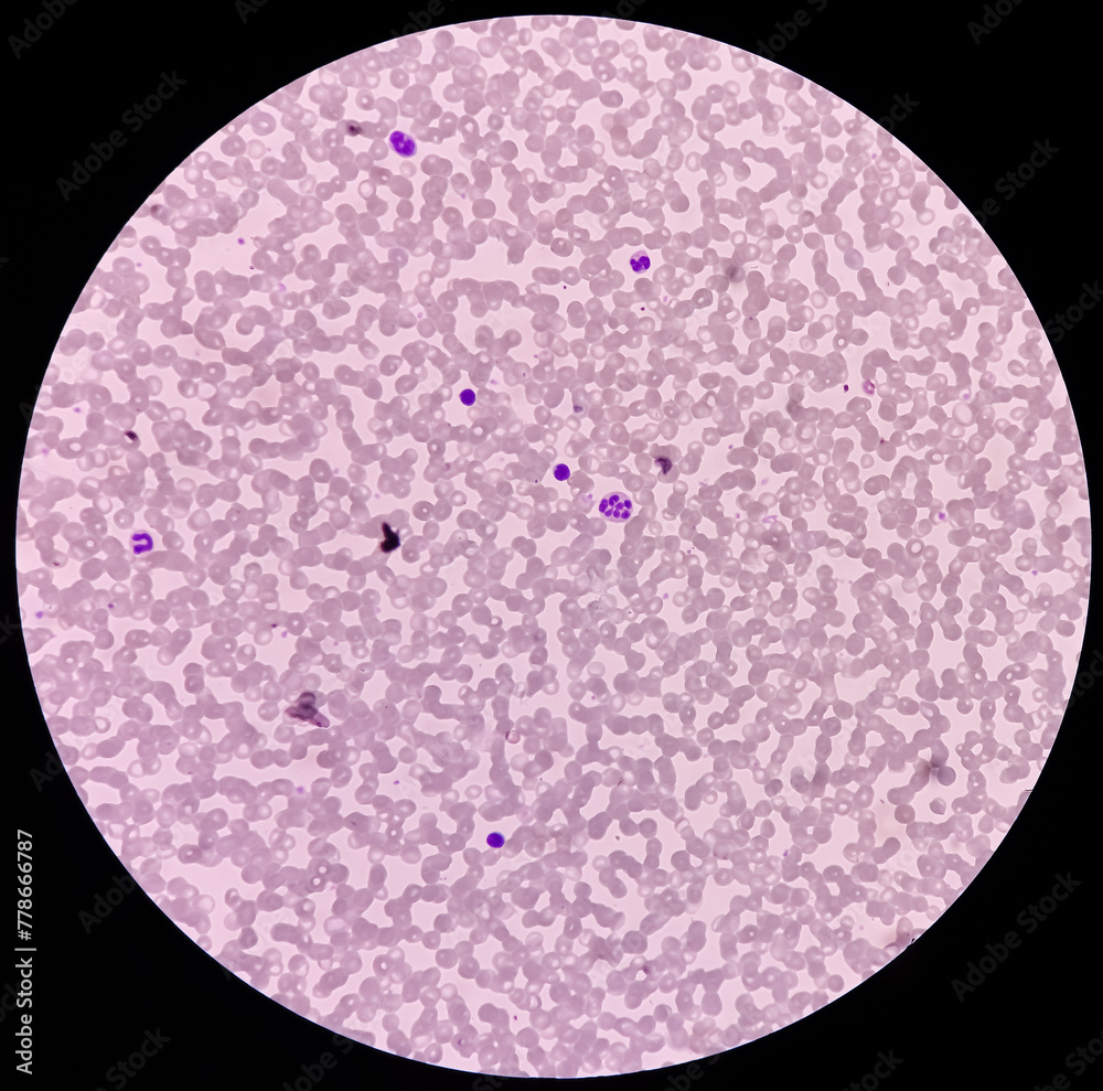 A peripheral blood smear, hypersegmented neutrophil was seen. Greater ...