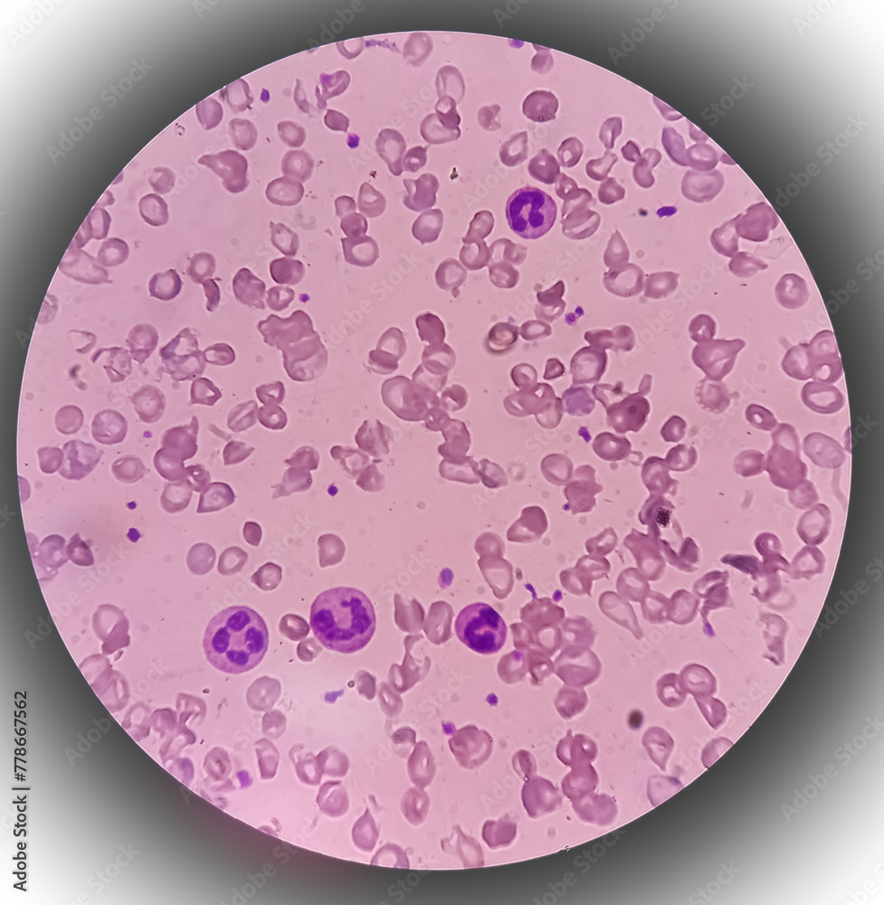 Acute leukemia, ALL(Acute lymphoblastic leukemia), peripheral blood ...