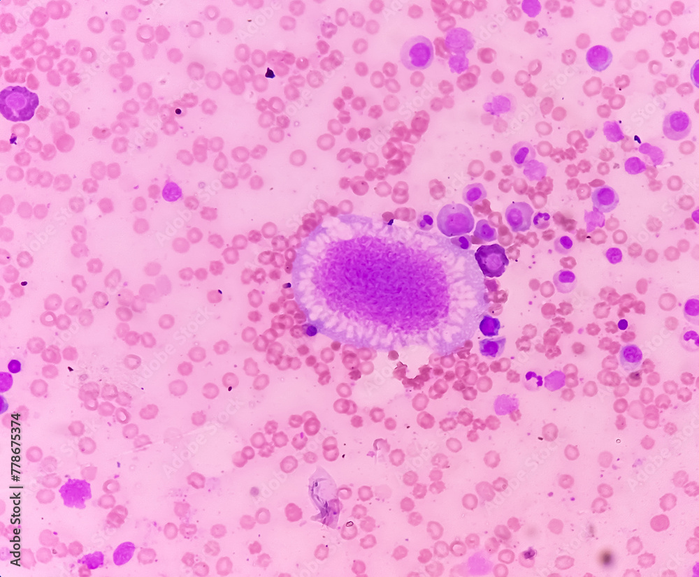 Acute leukemia, ALL(Acute lymphoblastic leukemia), peripheral blood ...