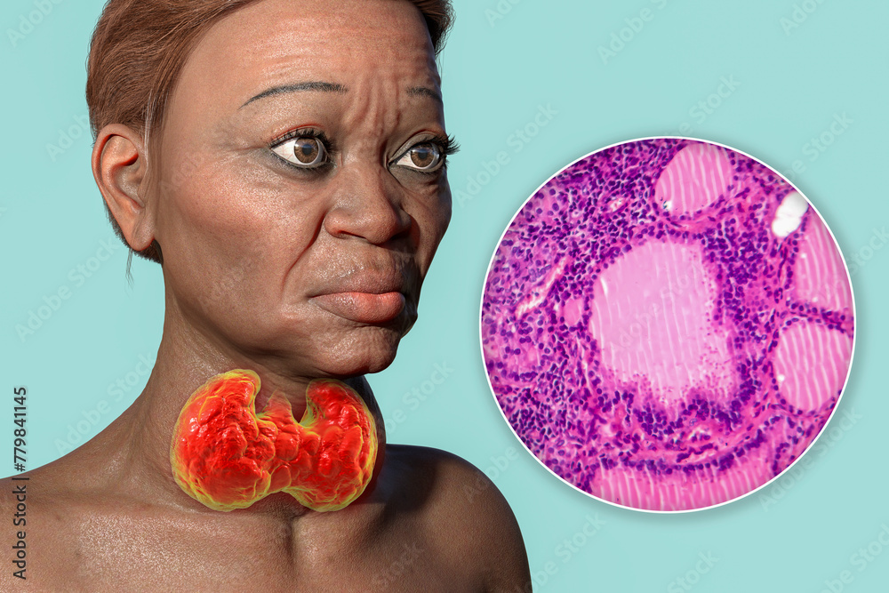 Grave's disease in a woman, 3D illustration and light micrograph of ...